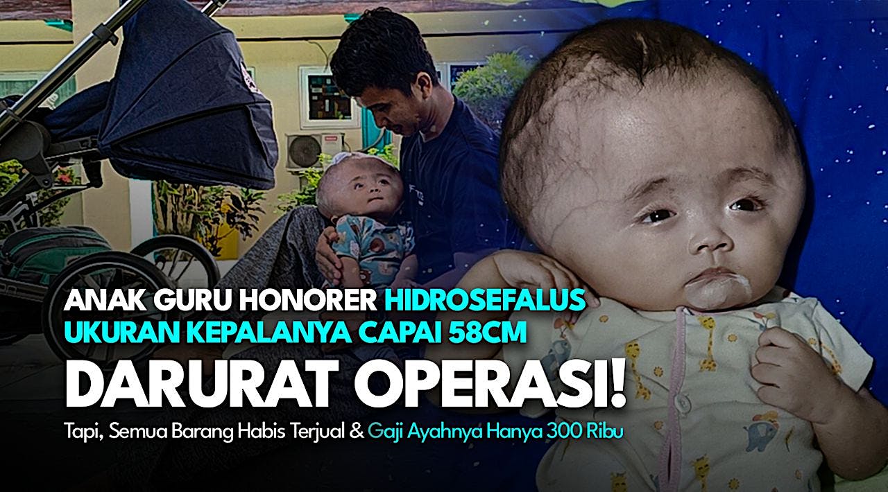 URGENT! Ukuran Kepala 58Cm Bayi 5Bln Butuh Operasi