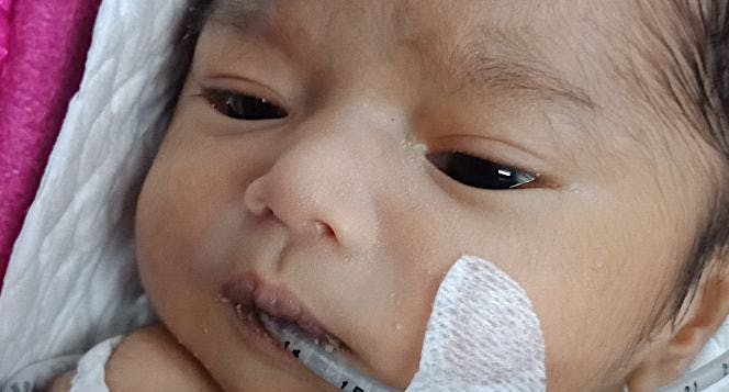 Bantu Baby Al operasi Hisprung