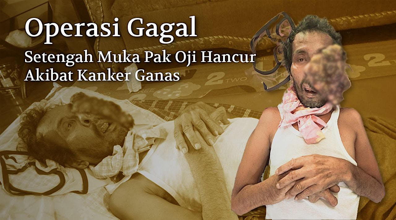 Sebagian Wajah Hancur Dilahap Kanker Ganas!